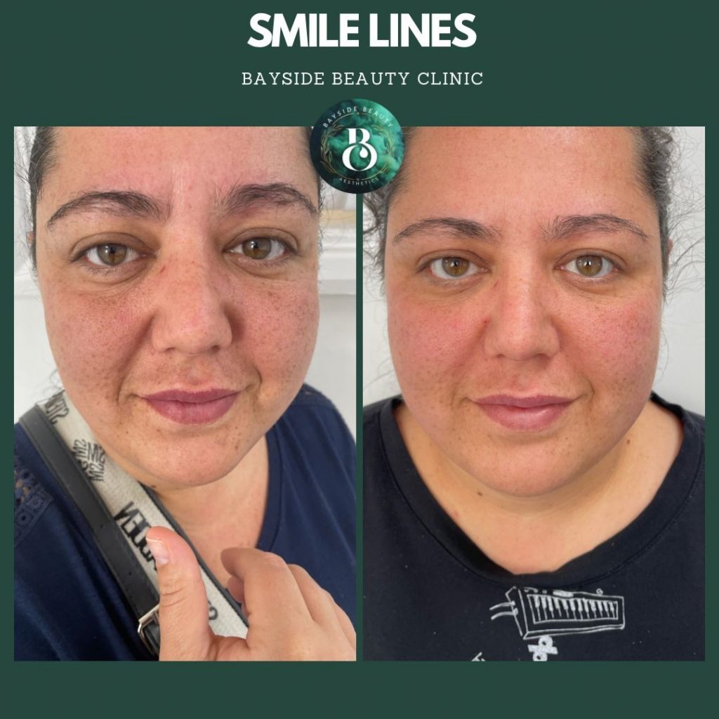 Smile Lines Filler